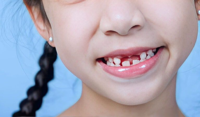 Are Spaces Between Your Child's Teeth Okay? in Awatukee, AZ - Jungle ...